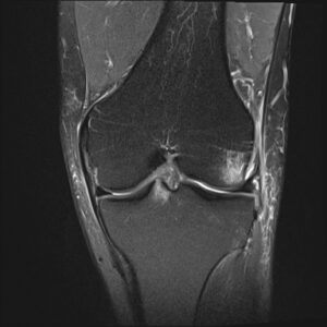 IRM du genou - Radiologie-Infiltration.ch