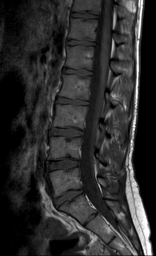 IRM du rachis - Radiologie-Infiltration.ch