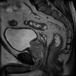 IRM de prostate - Radiologie-Infiltration.ch