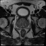 IRM de prostate - Radiologie-Infiltration.ch