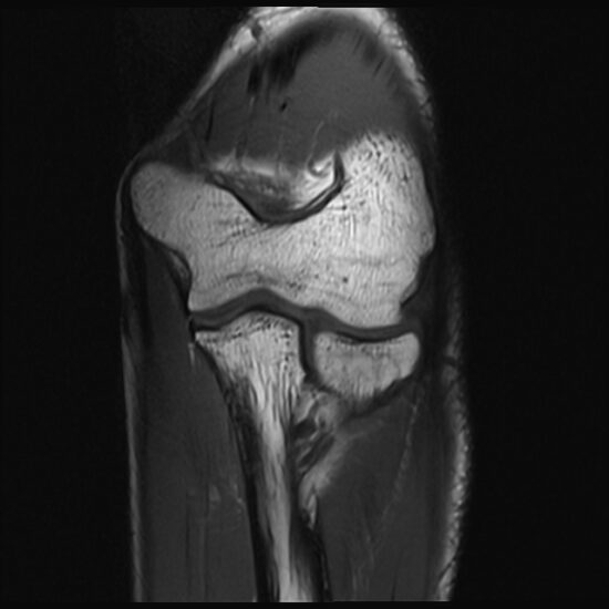 IRM du coude - Radiologie-Infiltration.ch