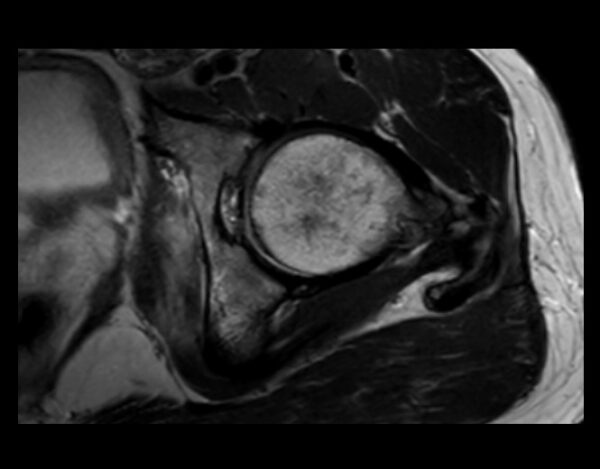 IRM de la hanche - Radiologie-Infiltration.ch